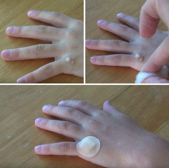 Metodă INCREDIBILĂ! Cum să îţi scoţi un NEG fără durere? Pielea ta va ...