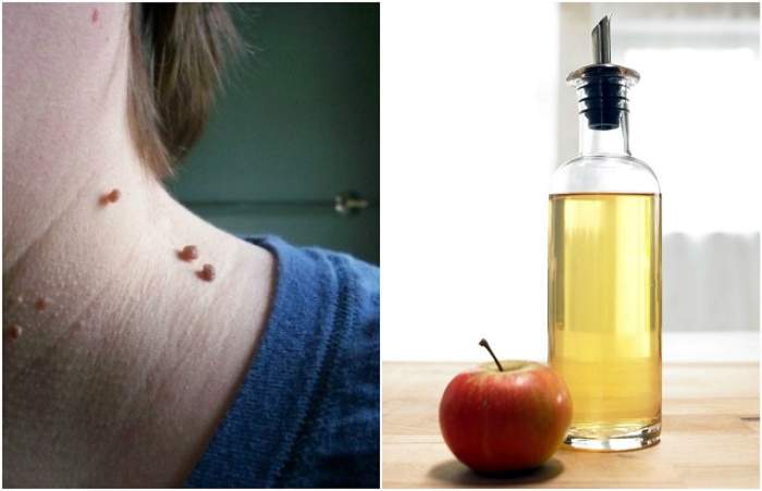 VIDEO / Cum să scapi de papiloame cu ajutorul oţetului! REZULTATELE ...